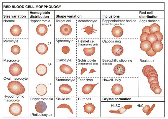 Summary Of Abnormal Red Blood Cell Morphologies And Disease States Summary Of Abnormal Red Blood Cell Morphologies And Disease States