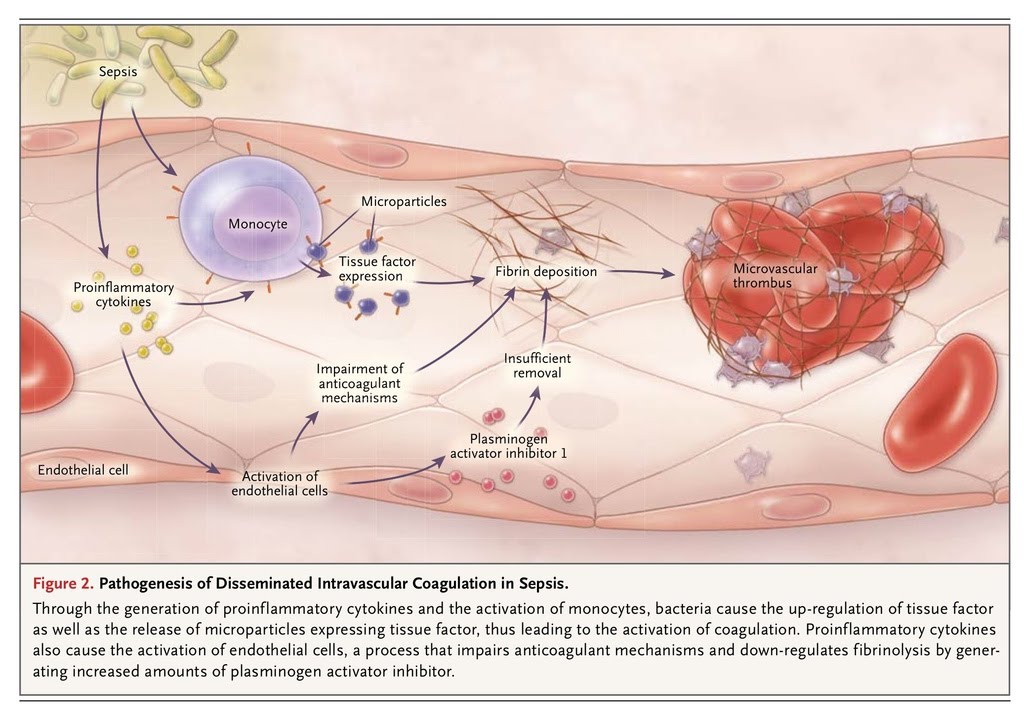 DIC Disseminated Intravascular Coagulation Medical Laboratories