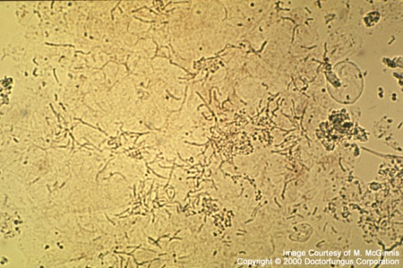 Tinea versicolor caused by Malassezia furfur infection and laboratory ...